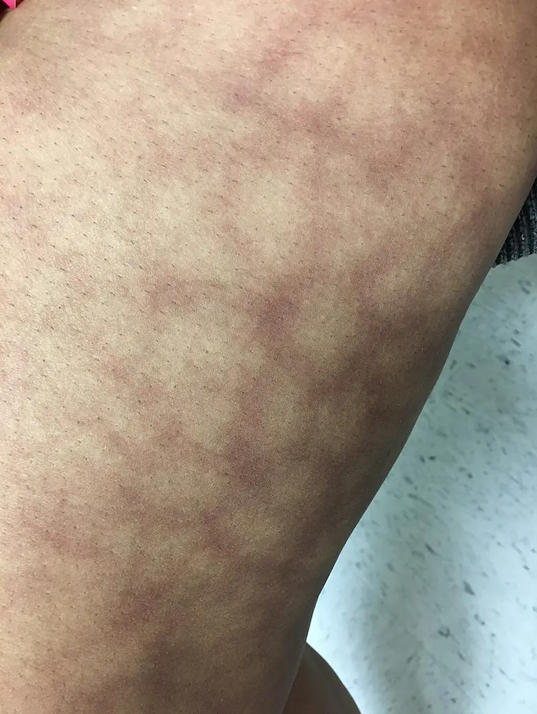 This skin change can be a sign that someone is about to die