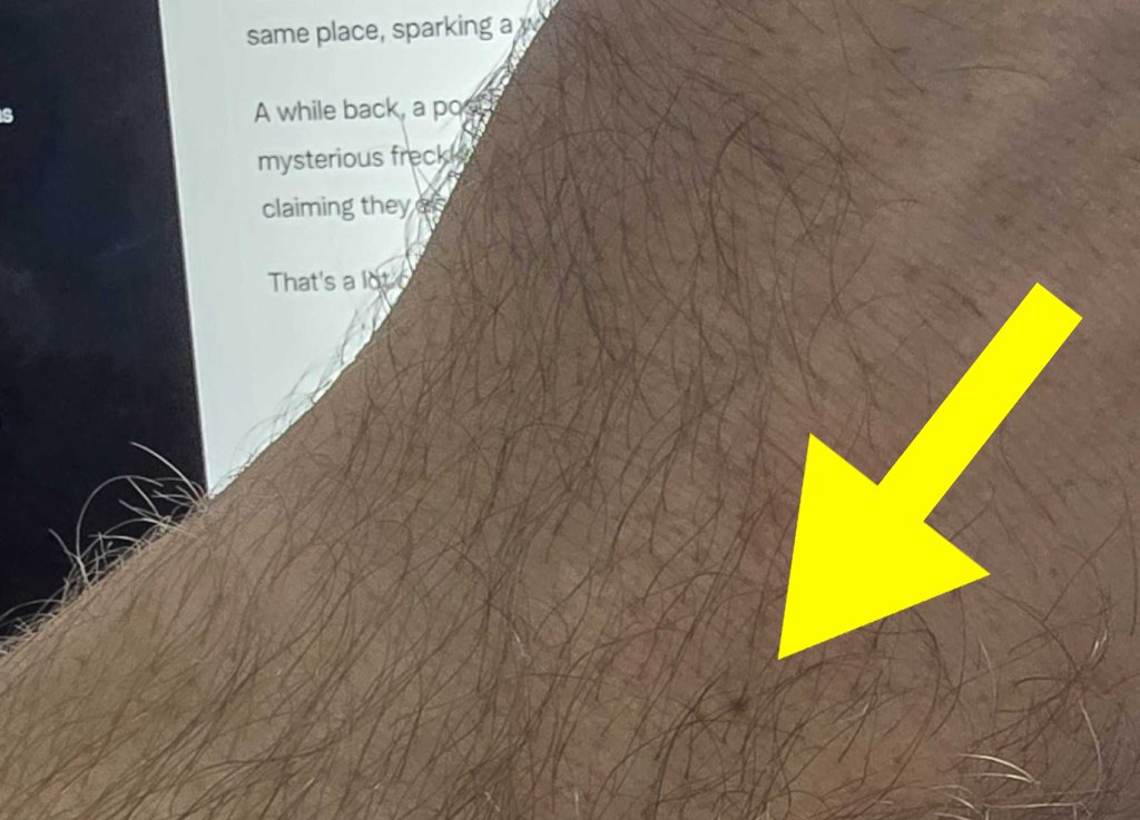 Reason Why So Many People Seem To Have The Exact Same Freckle In The ...