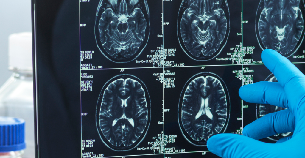 Dementia expert higlights five early‑onset dementia signs that aren't ...
