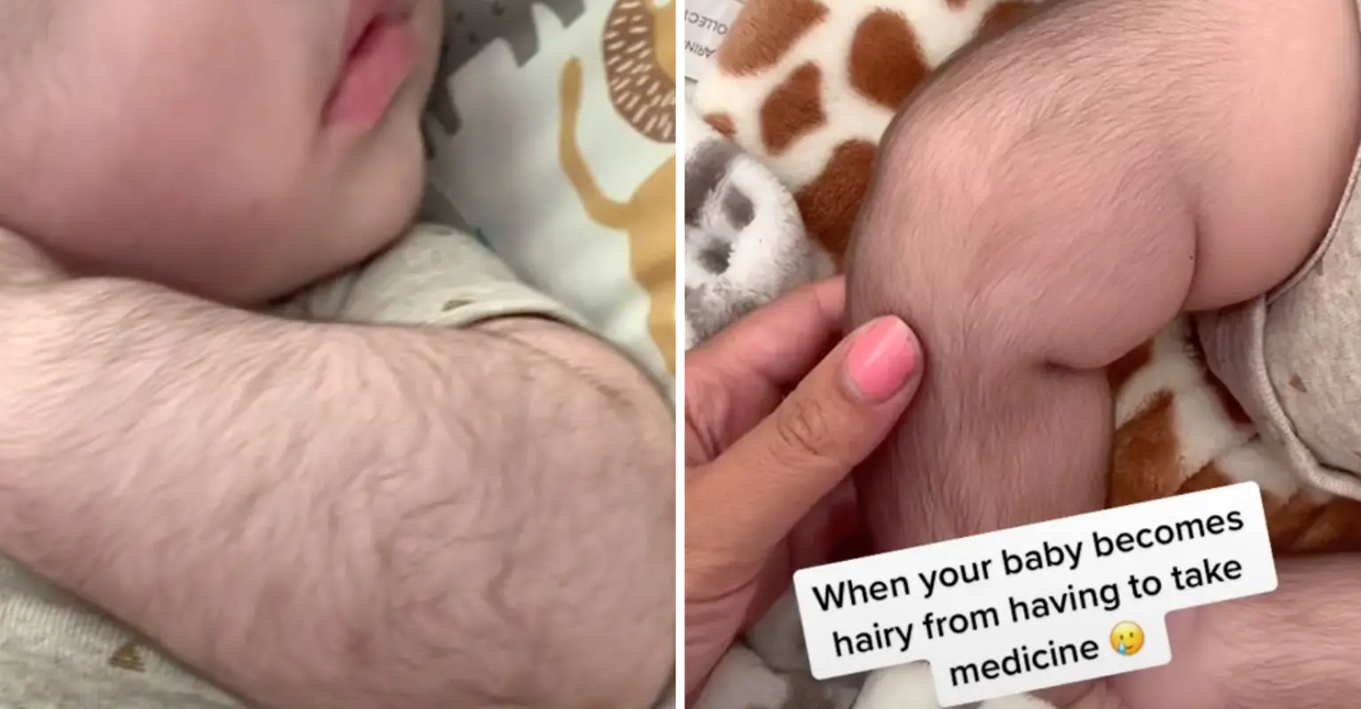 Adorable Baby Gains Thousands Of Fans After Medication Caused Excessive ...